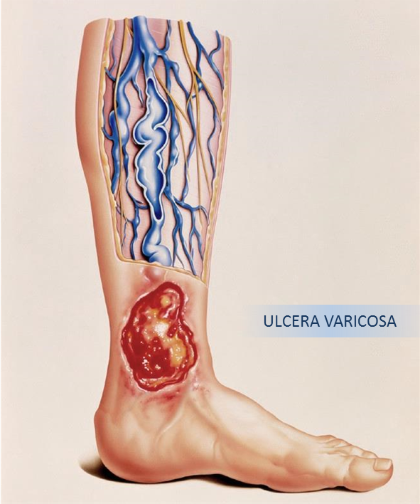 Úlcera Varicosa - Atención Vascular : Tratamiento de Várices, Ulceras ...