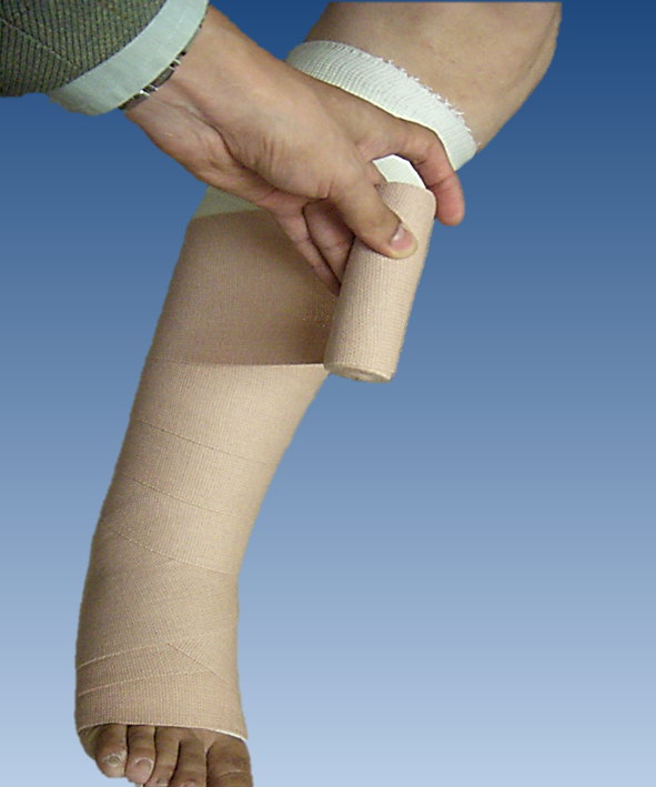 Úlcera Varicosa - Atención Vascular : Tratamiento de Várices, Ulceras ...