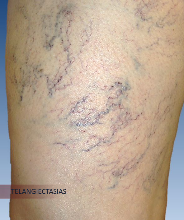 Várices - Atención Vascular : Tratamiento de Várices, Ulceras, Pie ...